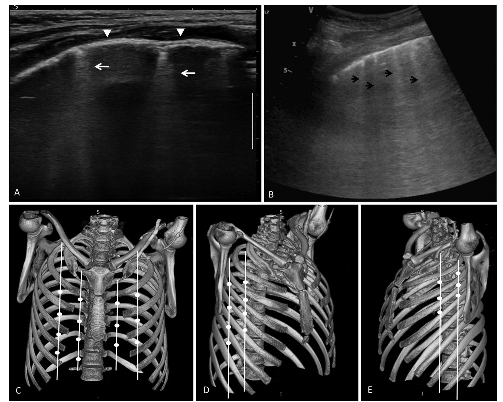 Lung ultrasound to assess pulmonary edema. (a) intercostal