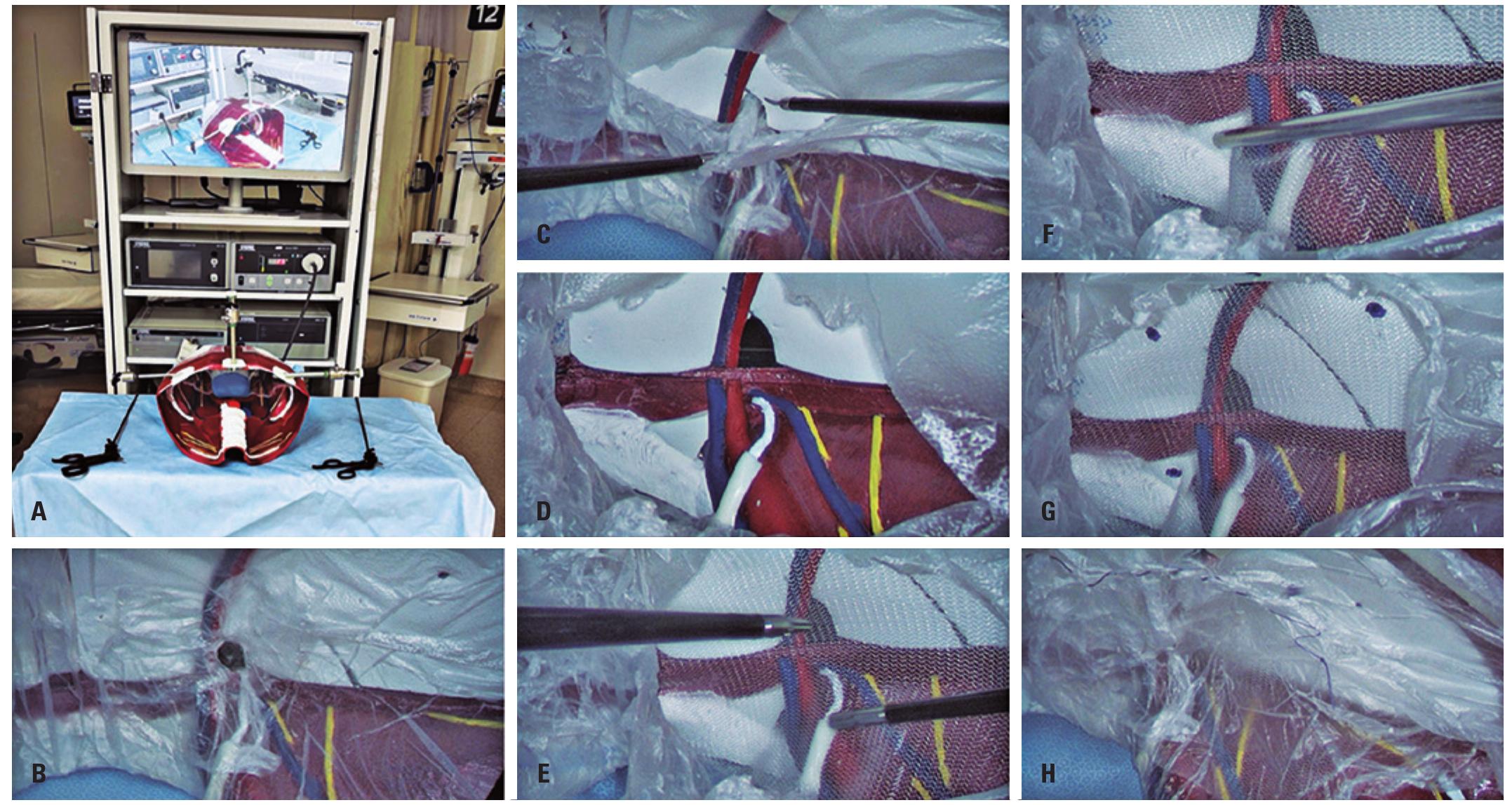 Placement of trocars (a); right lateral inguinal hernia (b);