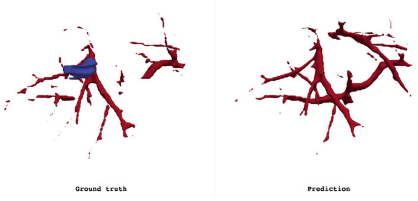 Semi-supervised deep learning for liver tumor and vessel