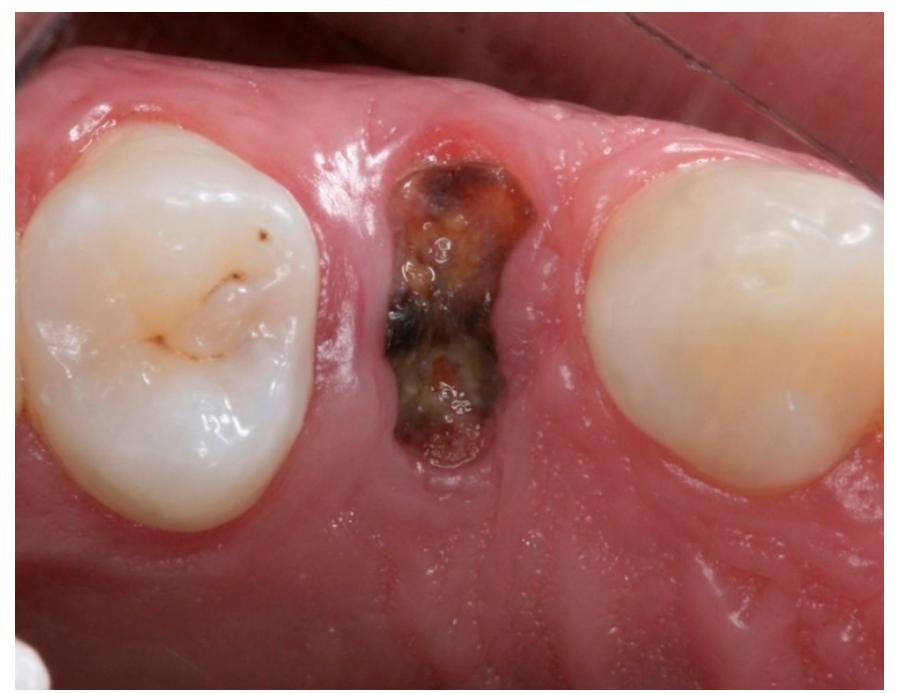 Intraoral occlusal preoperative view of tooth 14.