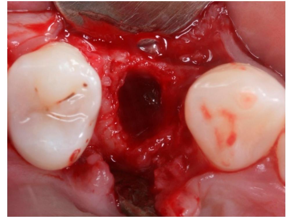 Intraoral occlusal view after extraction of tooth 14 (tg1).