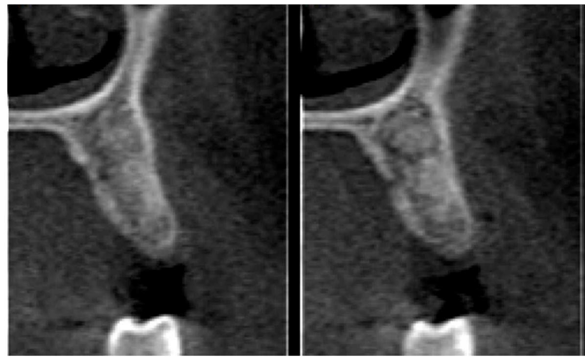 Ct images of tooth 24 (tg2) 4 months after the procedure.