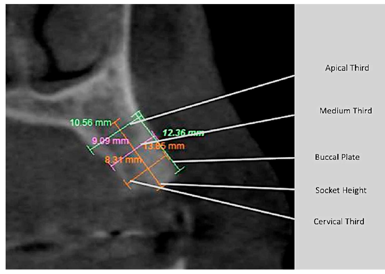 Scheme of the ct measurements, using dentalslice software.