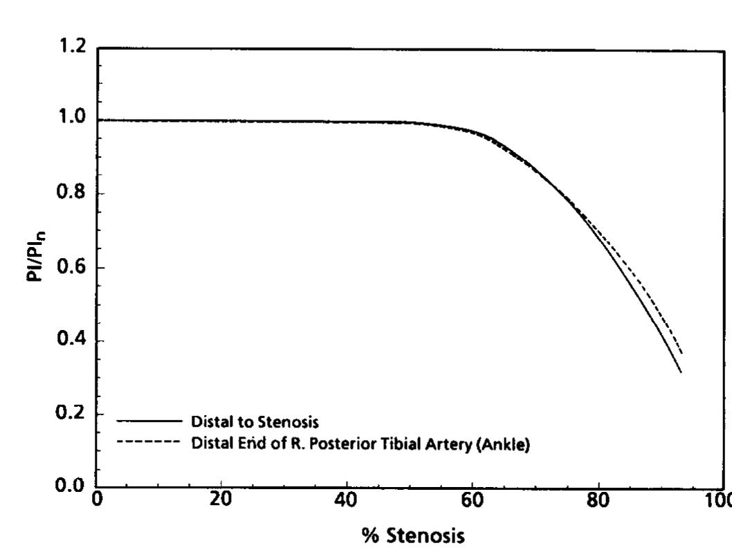 Effect of femoral stenosis severity on pulsatility index.