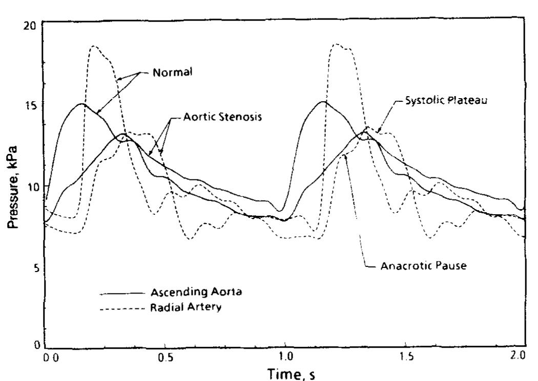 Aortic and radial pressure waveforms for normal flow and