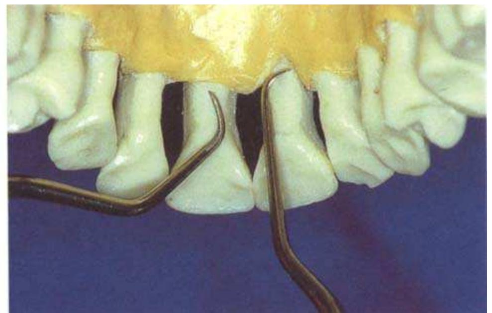 Rigid standard gracey 7-8 curet adapted for a horizontal