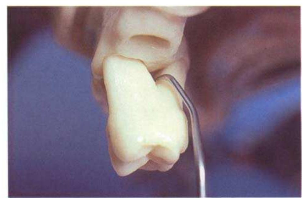 Gracey 11-12 curet adapted to the mesial fur- cation of a