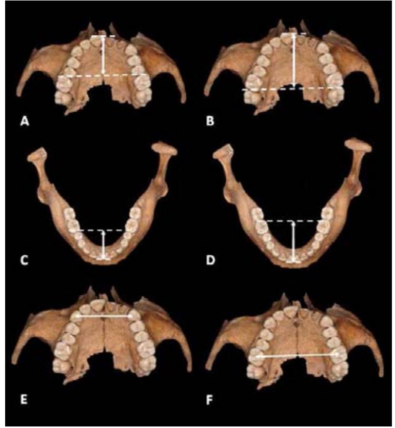 2.2: sagittal measurements: maxillary depth (a), and length
