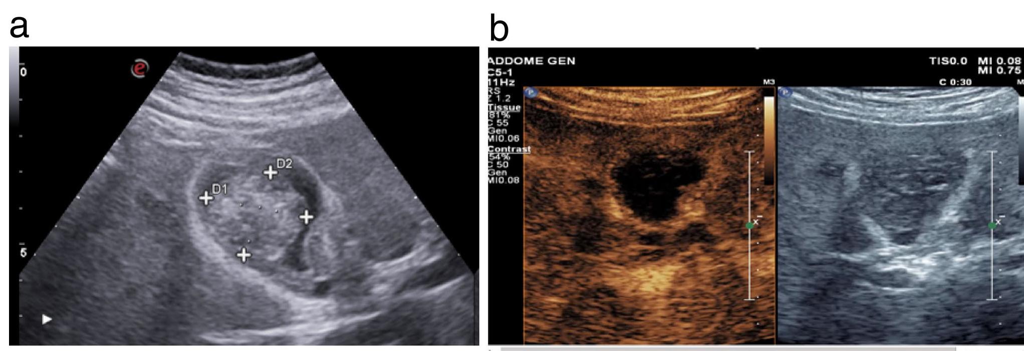 A the ultrasound image shows tumefactive biliary sludge that