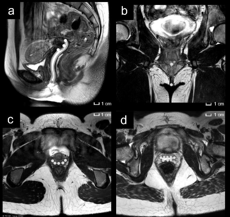 (PDF) Comparison of the Vaginal and Labial Dimensions of Nullipara ...