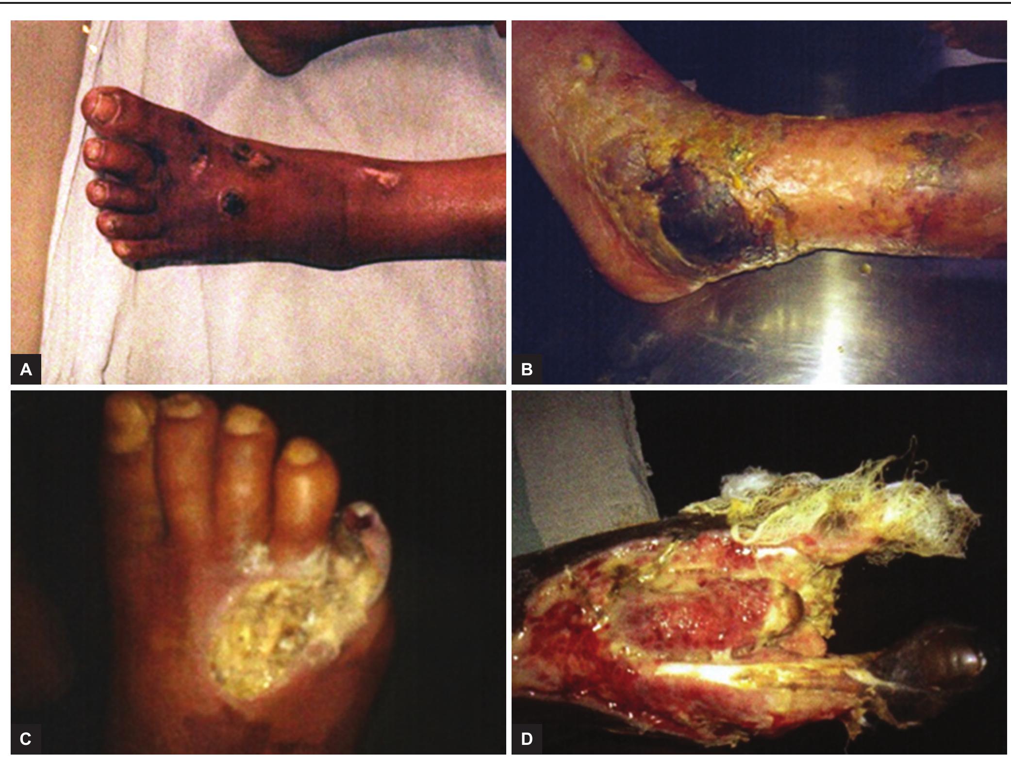 S 1a to d: different grades of diabetic foot ulcers: (a)