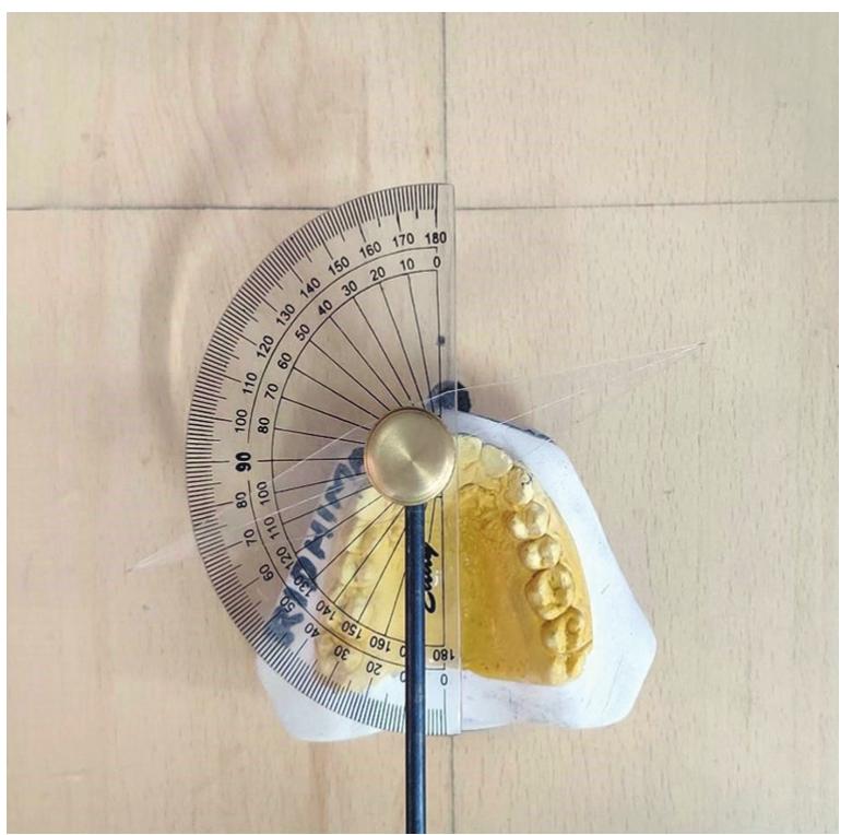 Mesiodistal angulation of right lateral incisor in incisal