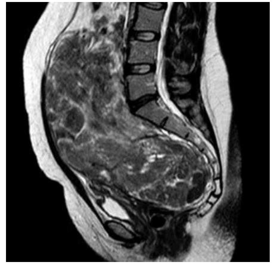 Sagittal plane mri of the giant cervical fibroid.