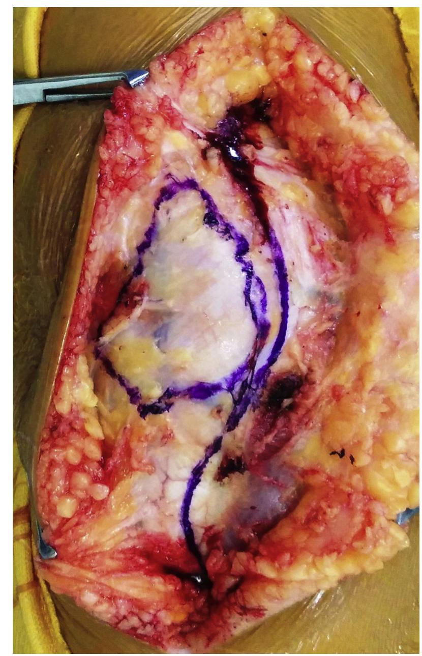 - clinical image depicting the incision for medial