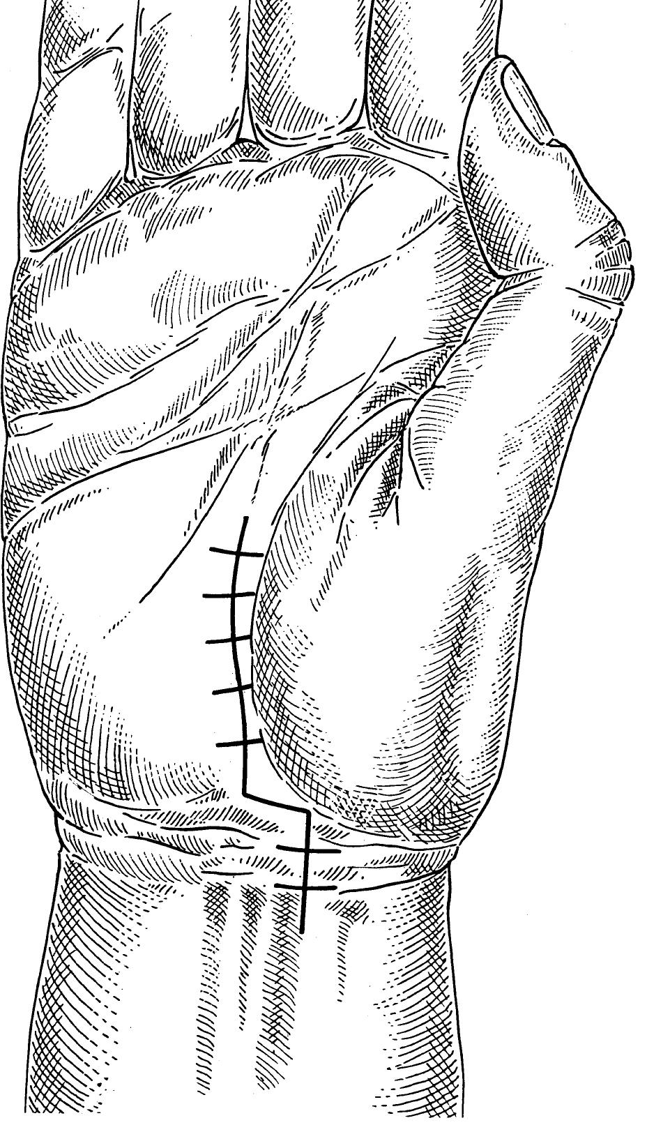 Anterior approach: skin incision. the scaphotrapezium joint