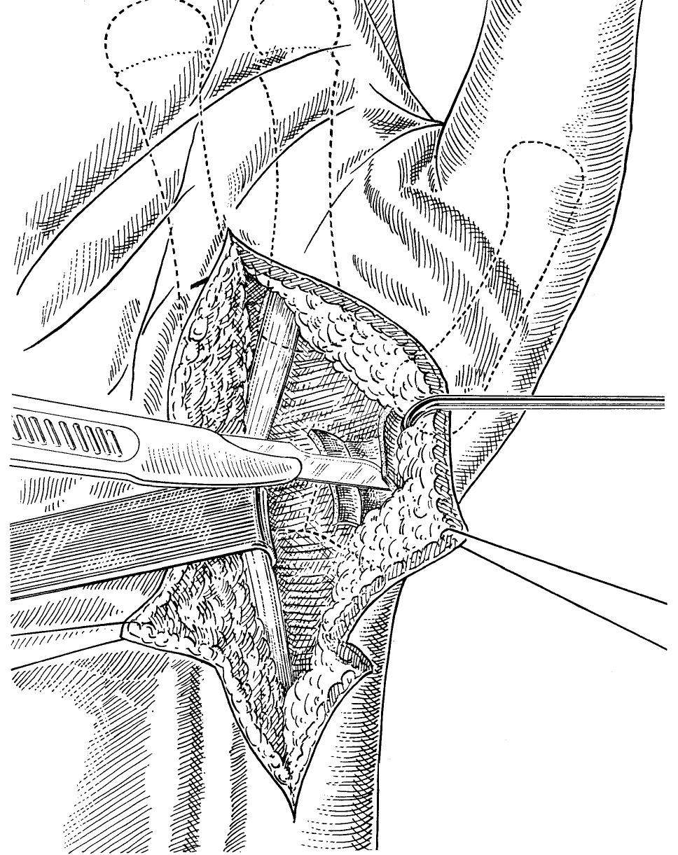 Approach of the trapezium after ulnar dislocation of the