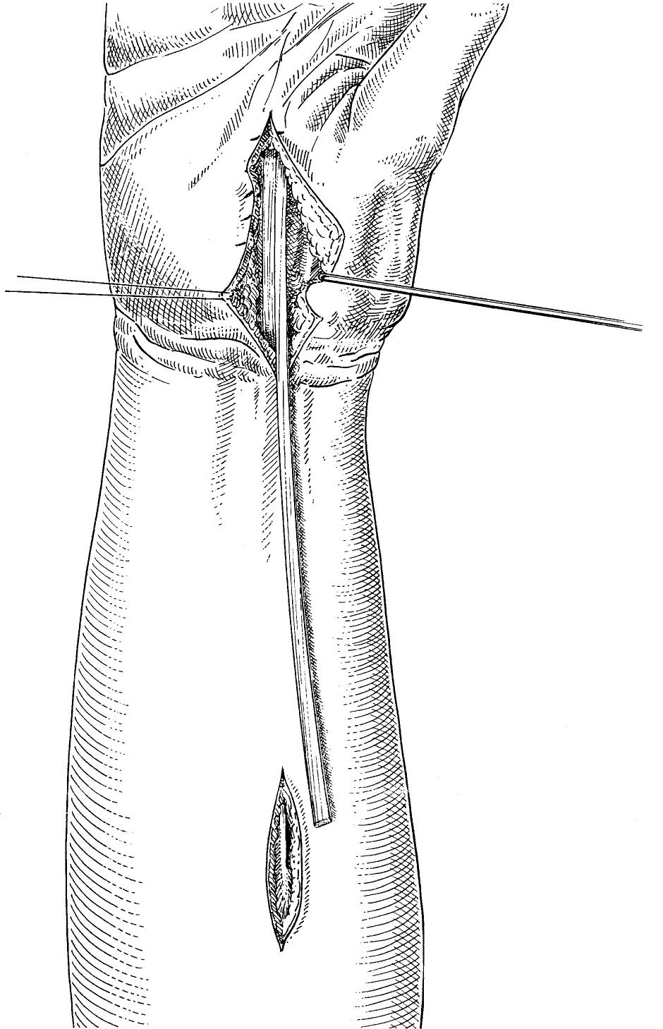 A tendon slip from the radial half of the flexor carpi