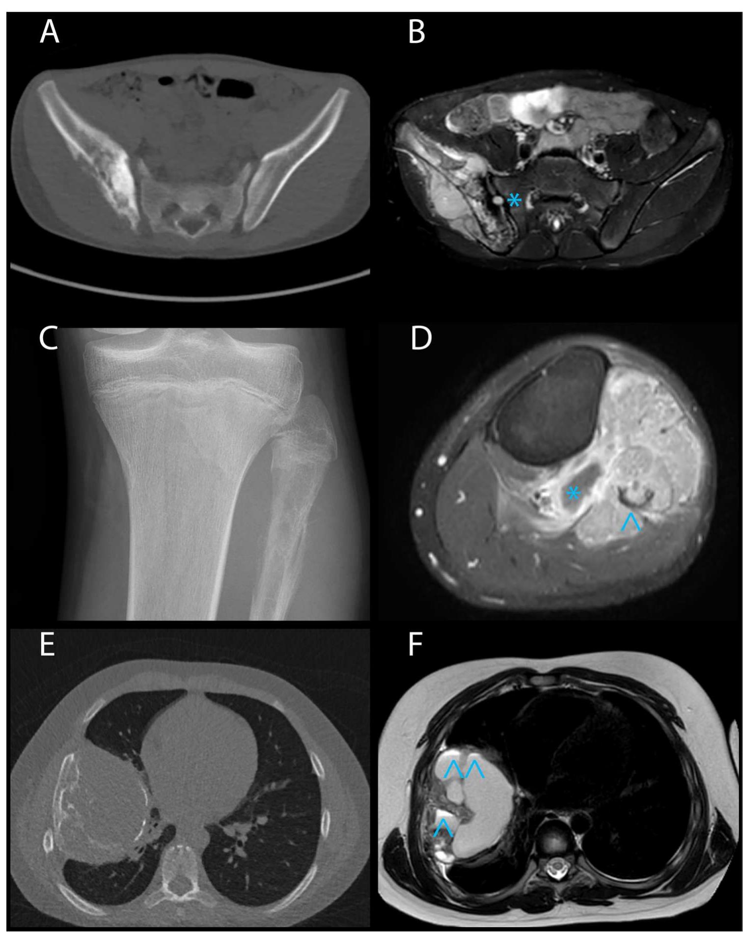 Radiology of fdrcs. a case 12: non-contrast pelvis ct scan