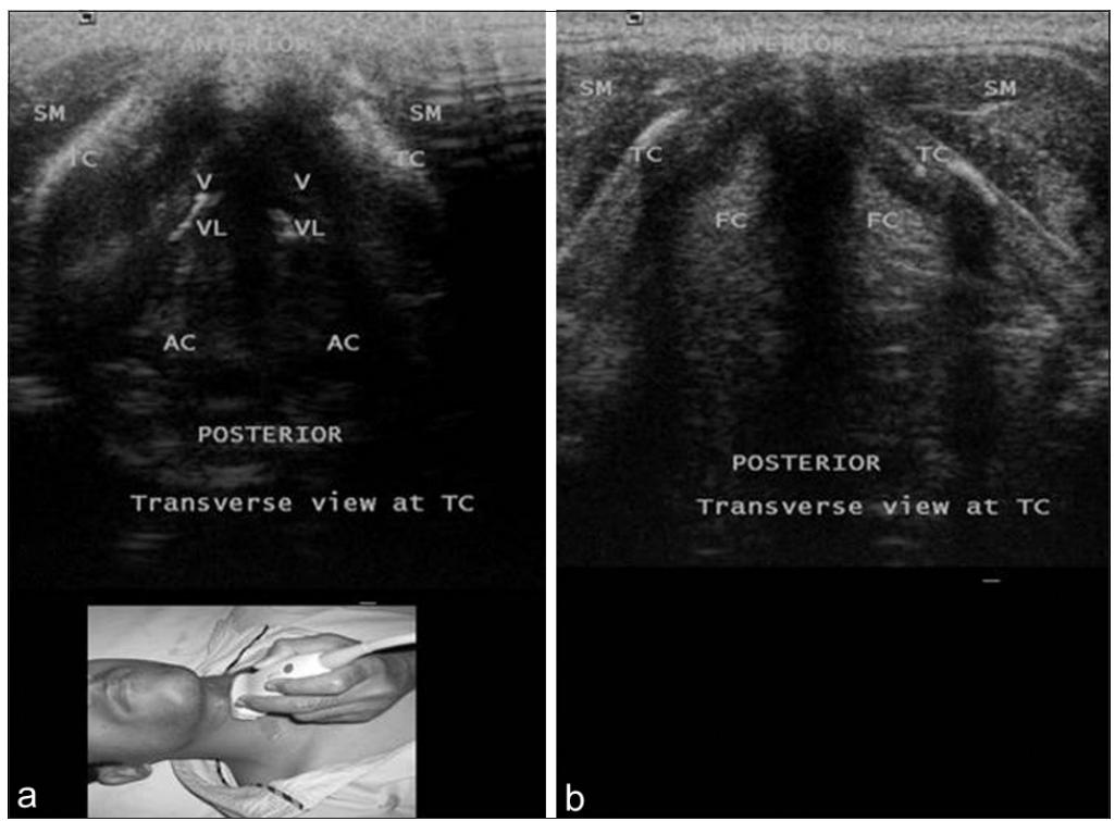 (a) midline transverse view at hyoid. (b) transverse view at
