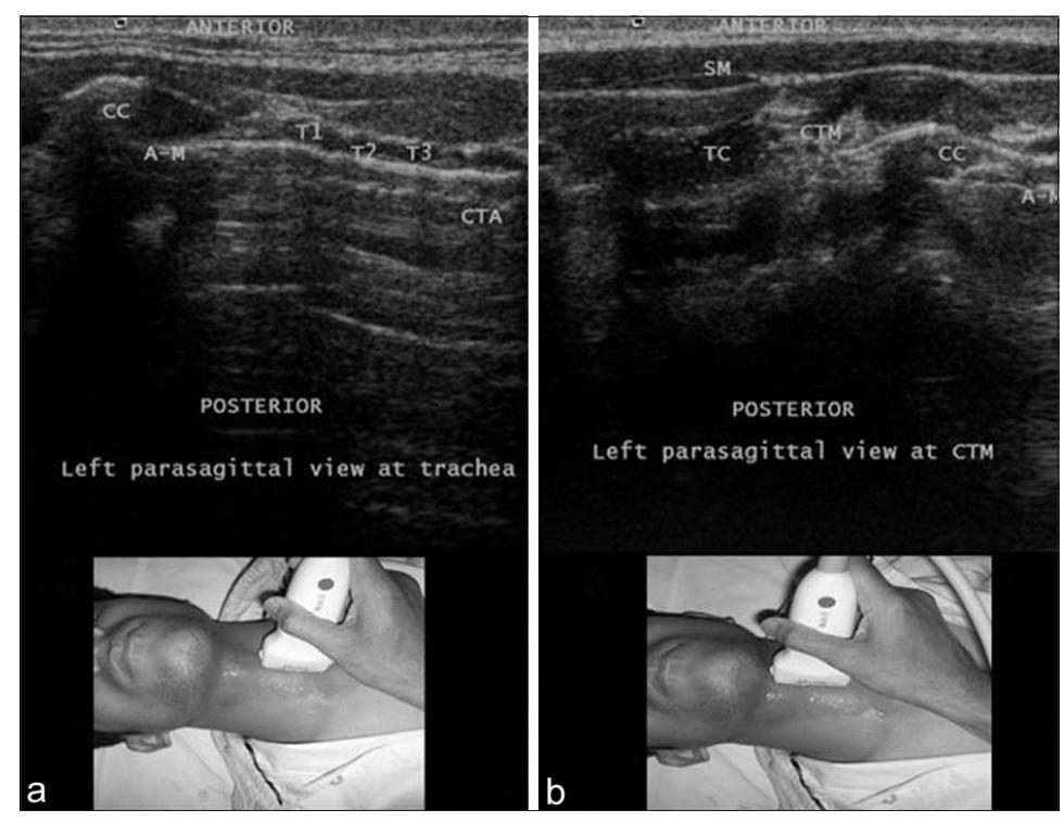 (a) left parasagittal view at trachea. (b) left parasagittal