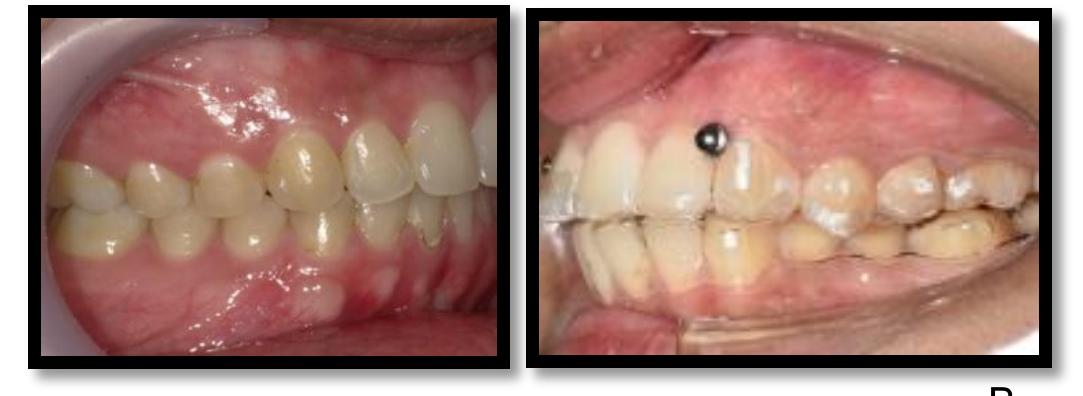 Pre and post distalisation intraoral photographs. a: self-