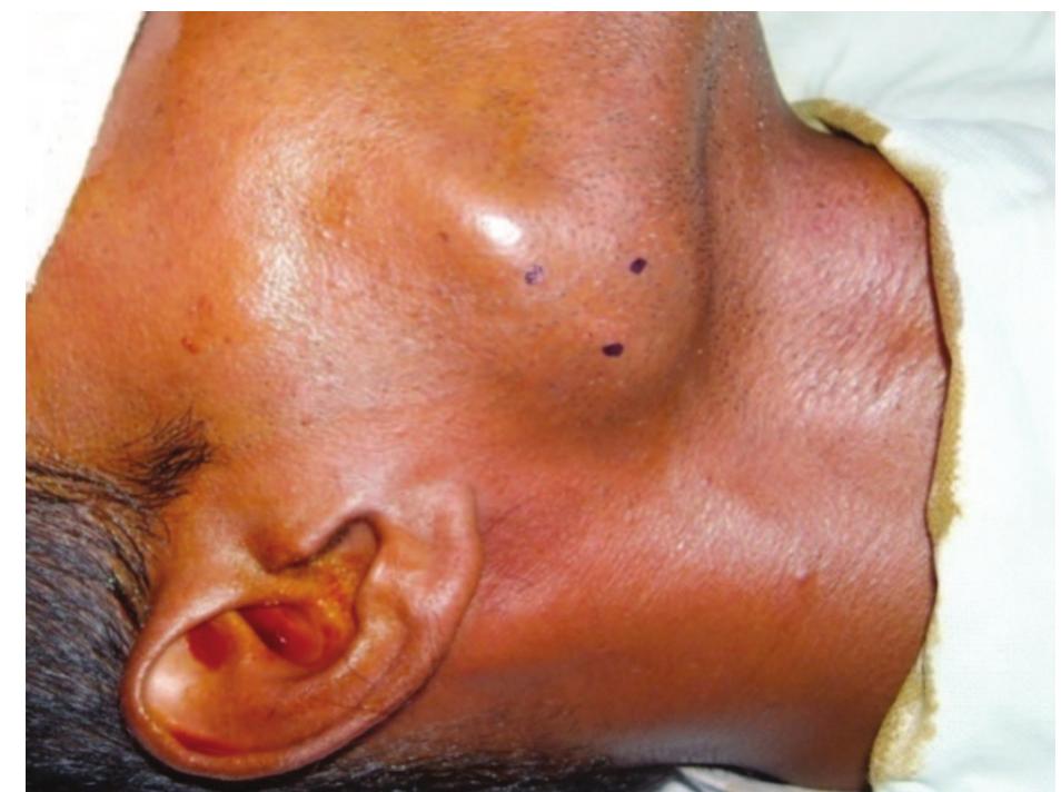 The site of injection with botulinum toxin in masseter