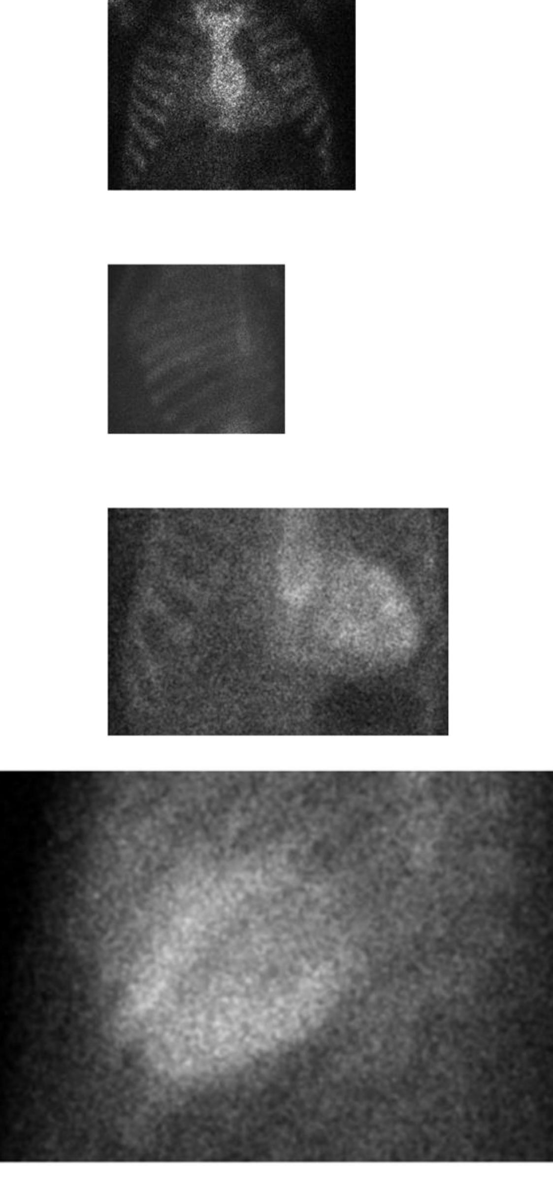 A-d. tc99m pyrophosphate (pyp) scans in ap and lateral