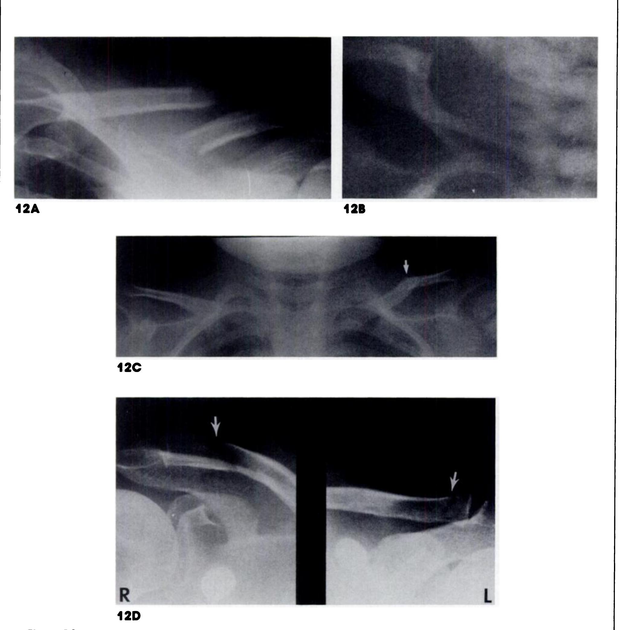 Figure 12 - from The clavicle: normal and abnormal