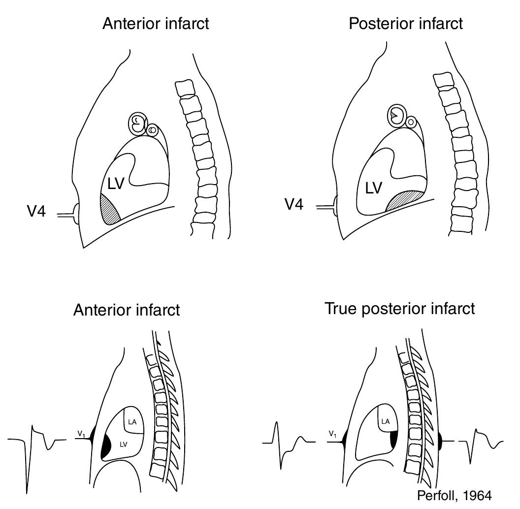 6 above: the concept of anterior and posterior infarction