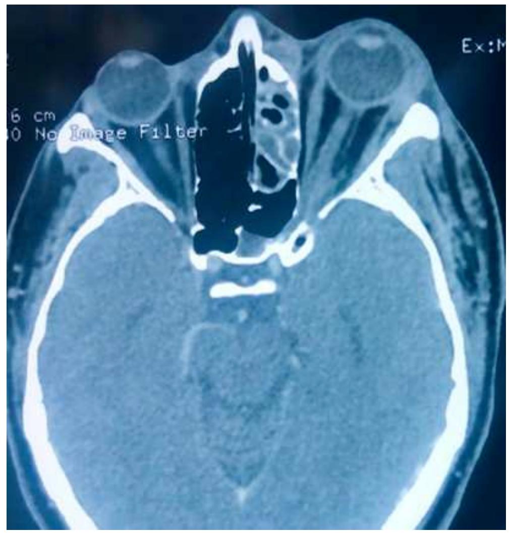 (PDF) Orbital apex syndrome: A review
