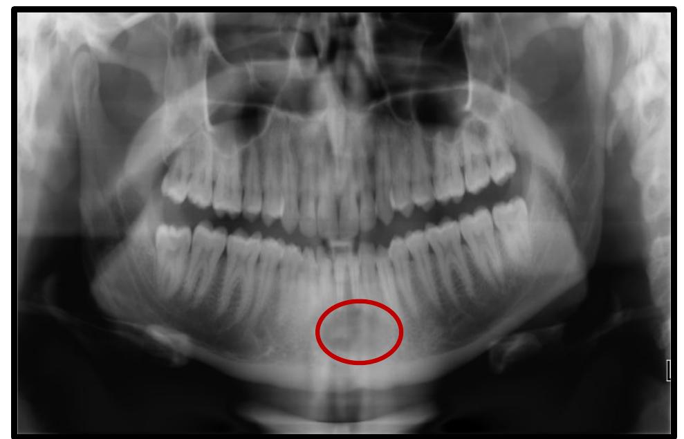 Bee figure 3a and 3b. iopar and occlusal radiographs of