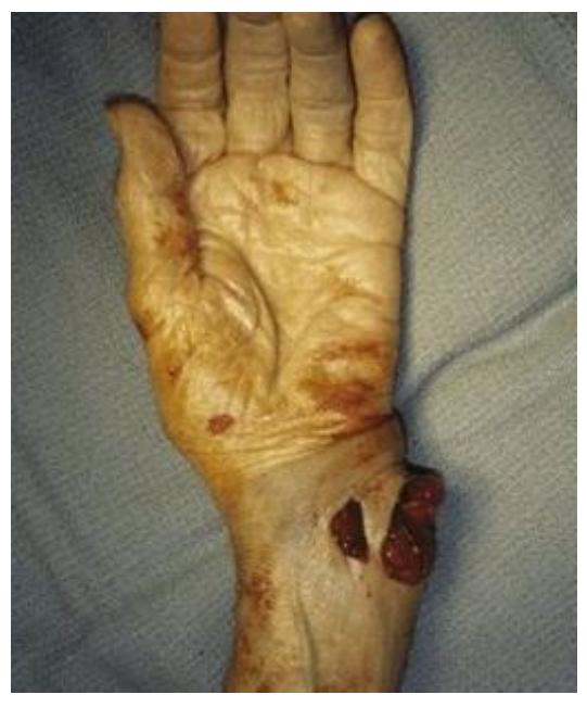 Open distal radius fracture