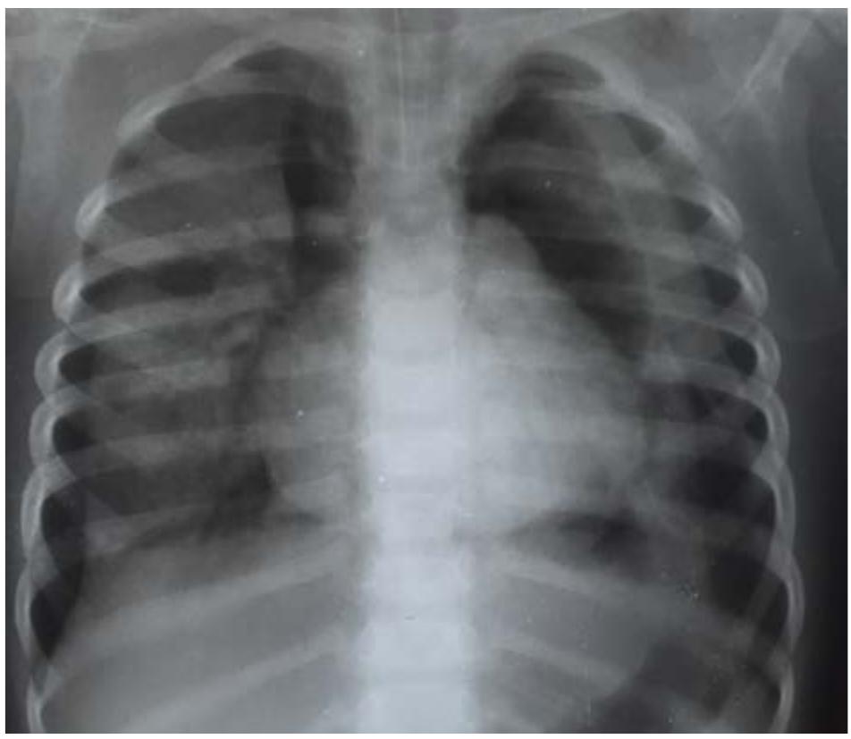 Bilateral pneumothorax. pneumomediastinum. the pulmonary