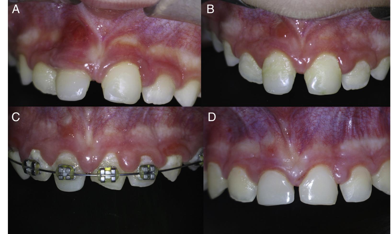 (4) preoperative labial view of maxillary anterior teeth
