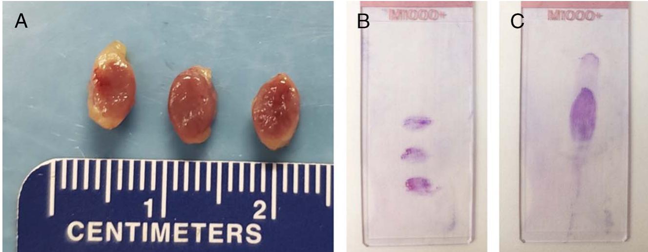 Intraoperative cytology in sentinel lymph node biopsy. a,