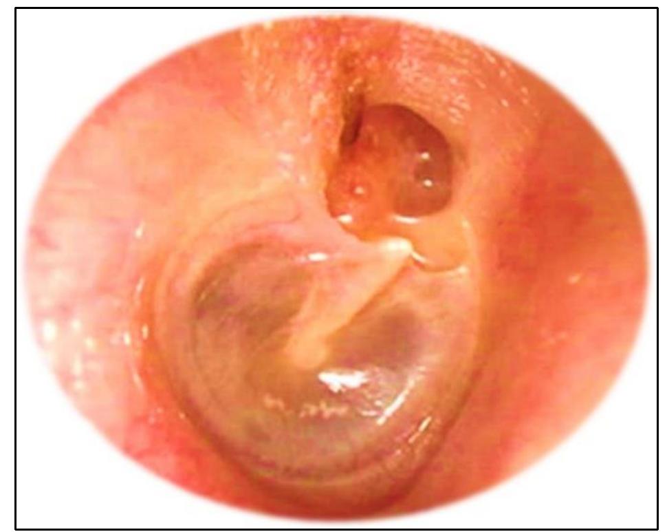 (PDF) Attic retraction pocket: a review