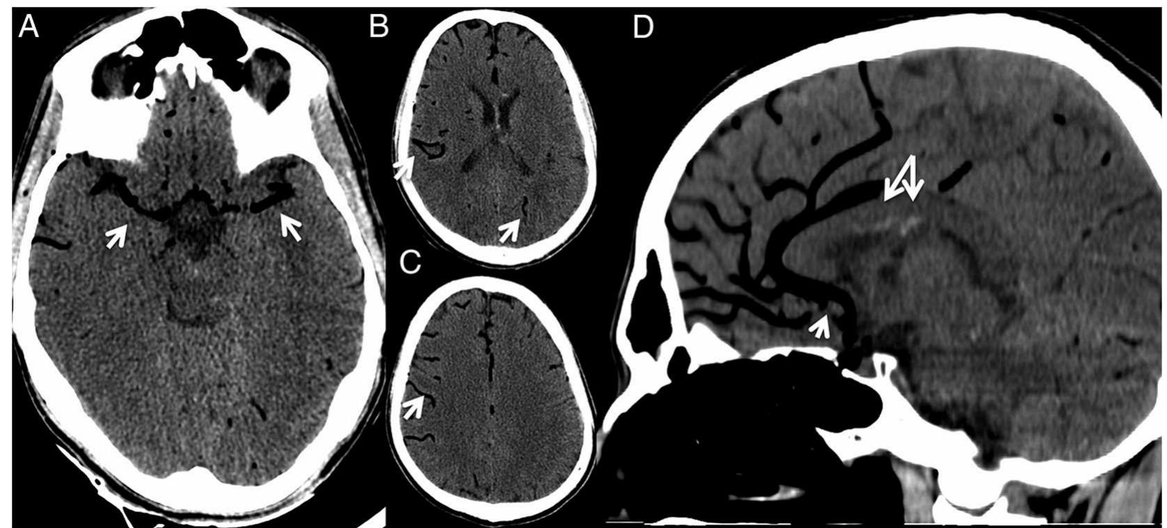 Axial ct of the brain showing hypodense intraluminal air