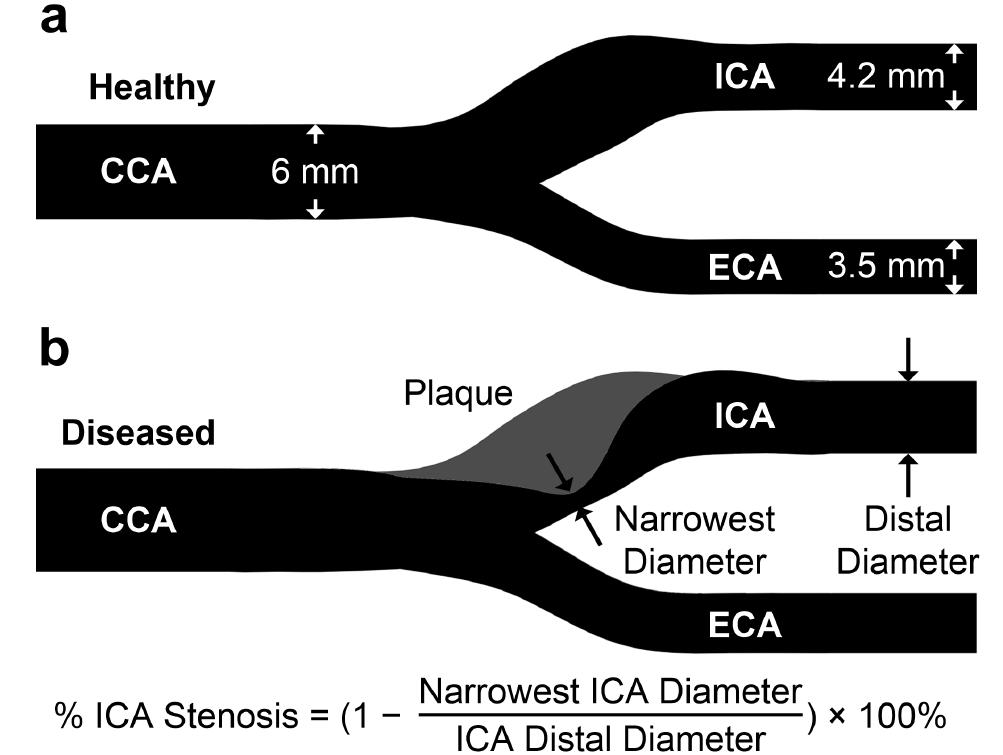 | overview of the carotid bifurcation geometry used in the