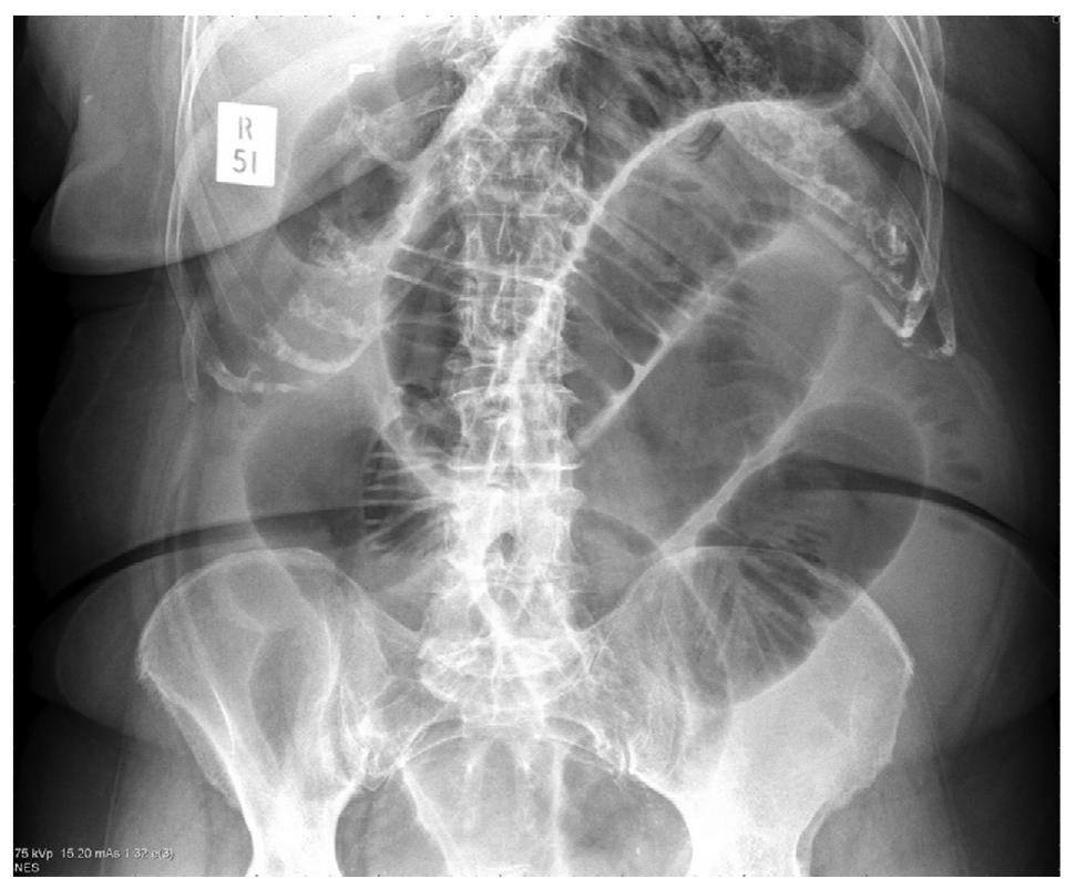 Plain abdominal x-ray showing distal small bowel obstruction