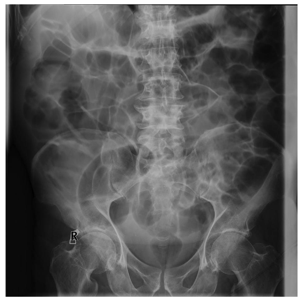 Plain abdominal x-ray showing an ileus (note dilated loops
