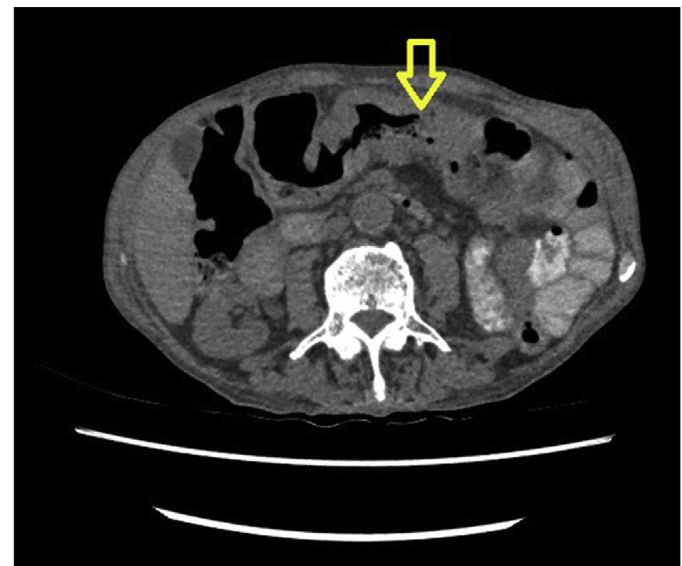 Ct showing large bowel obstruction with a cut-off in the