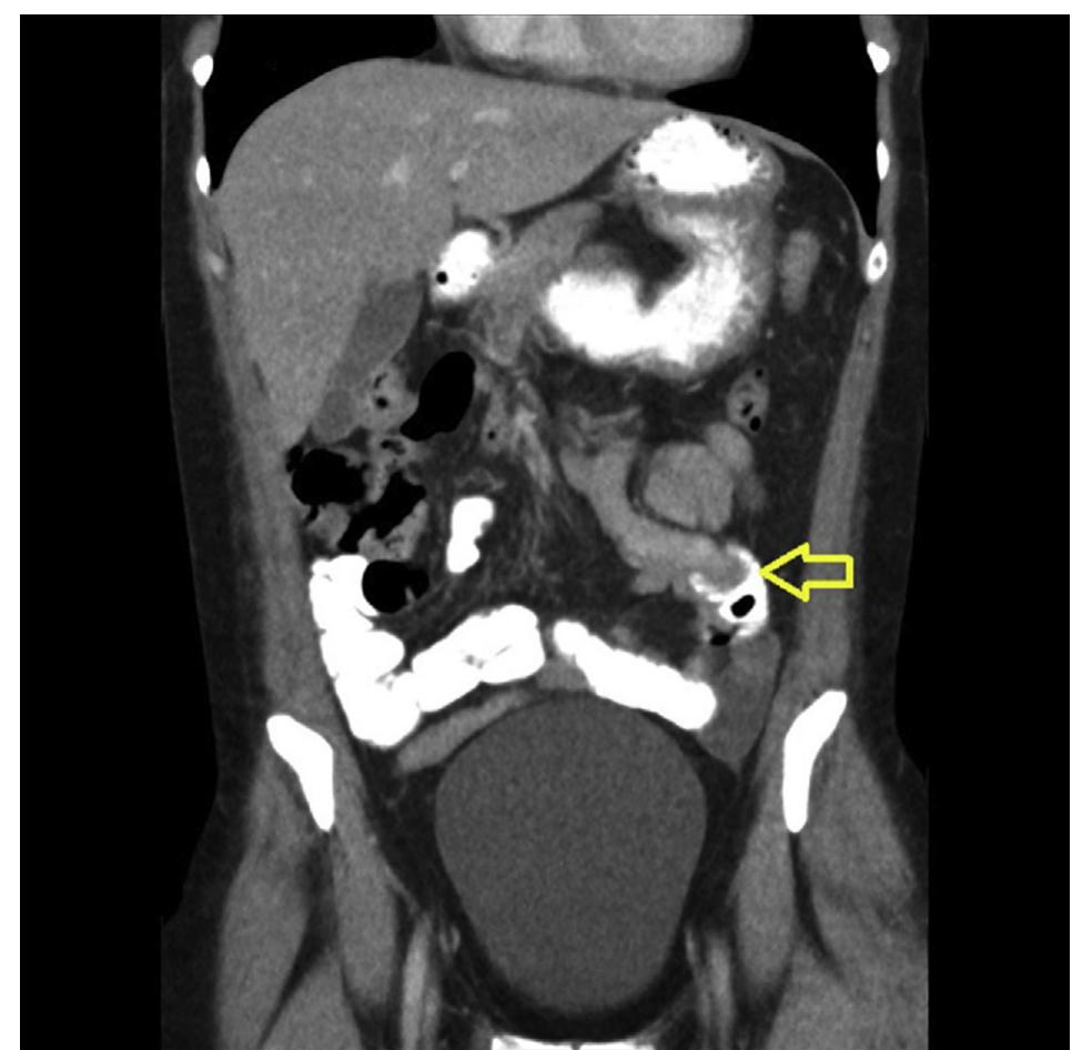 Ct showing small bowel obstruction due to intussusception.