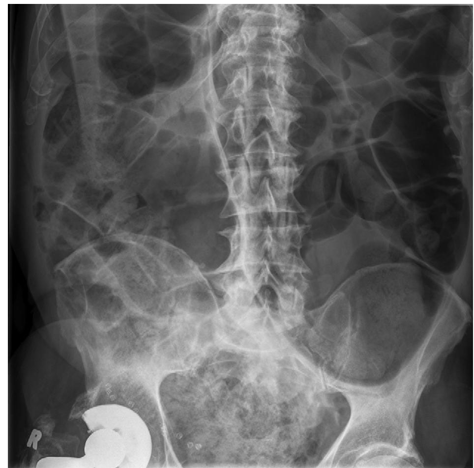 Plain abdominal x-ray showing a sigmoid volvulus.