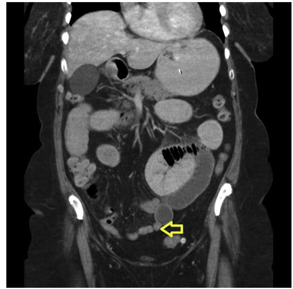 Ct showing distal small bowel obstruction with an abrupt