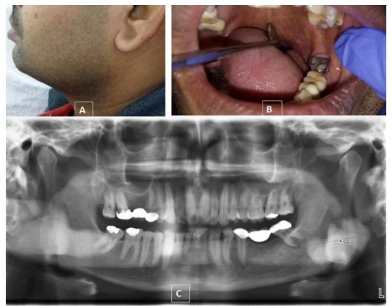 A. extraoral photograph showing a diffuse swelling over the