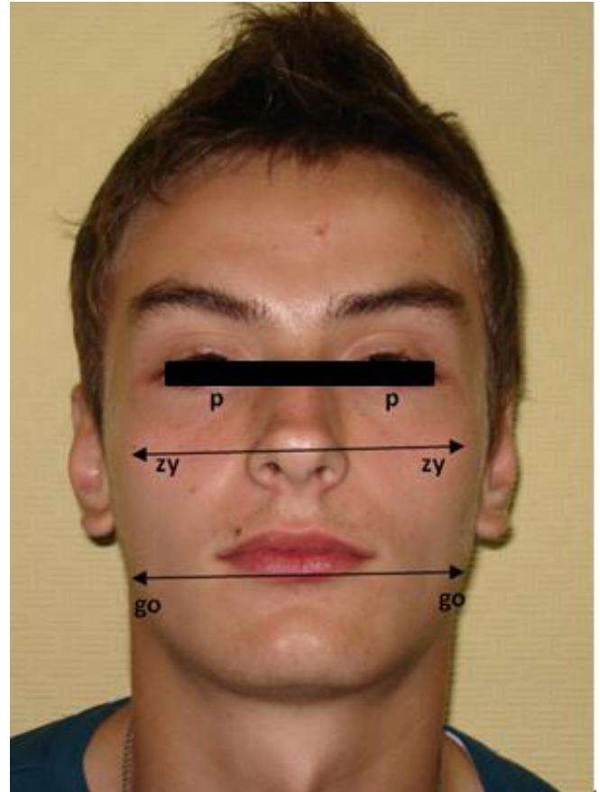 Patient a., aged 12, horizontal type of mandibular growth,