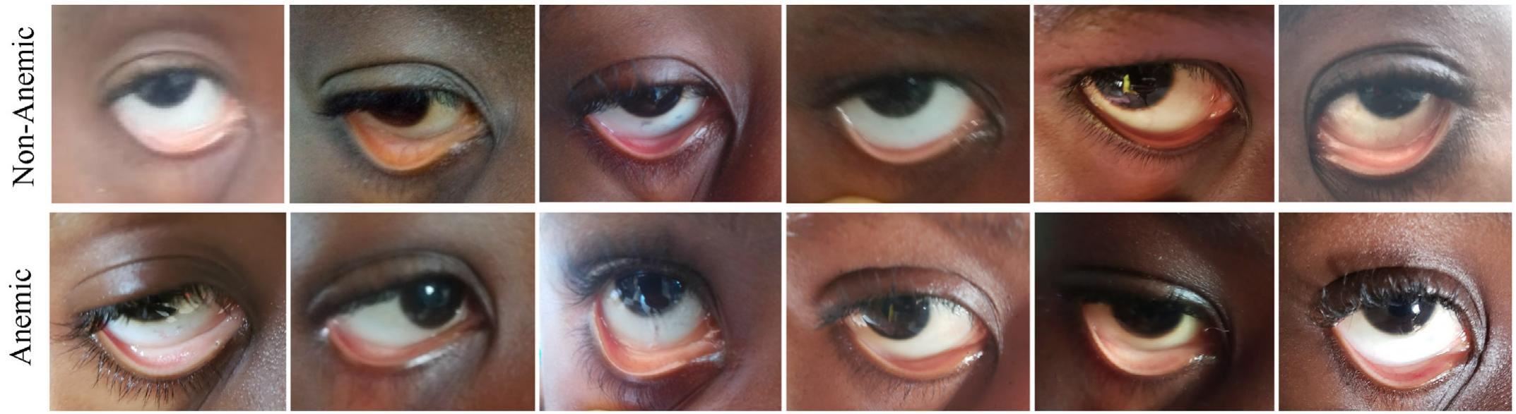 Exemplar conjunctival pallor images in our cp-anemic