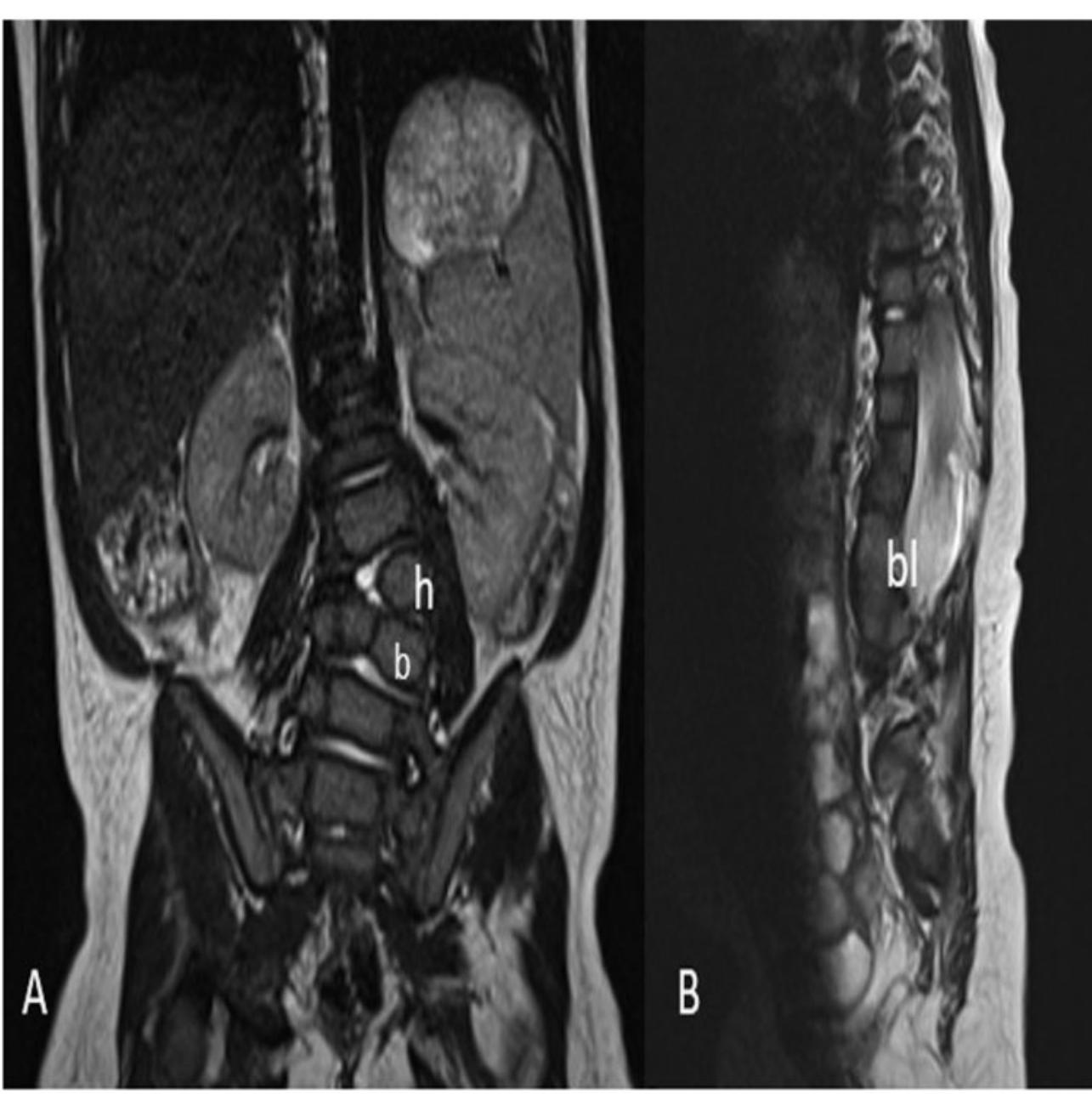 I. vertebral anomalies. (a) formation defects, i.e.