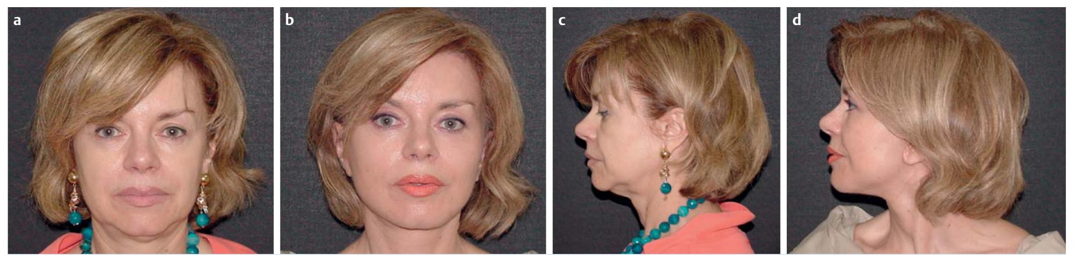 Figure 6 - from Midface Lift: Our Current Approaches