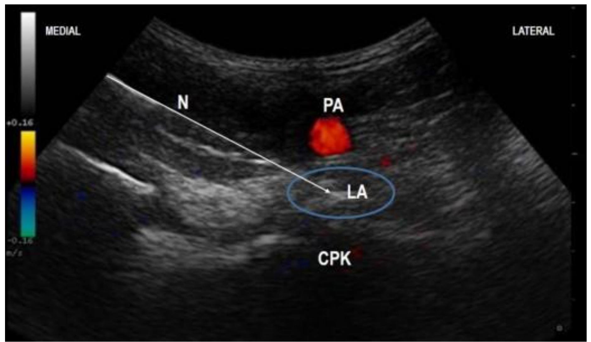 (PDF) The ultrasound‐guided iPACK block with continuous adductor canal ...
